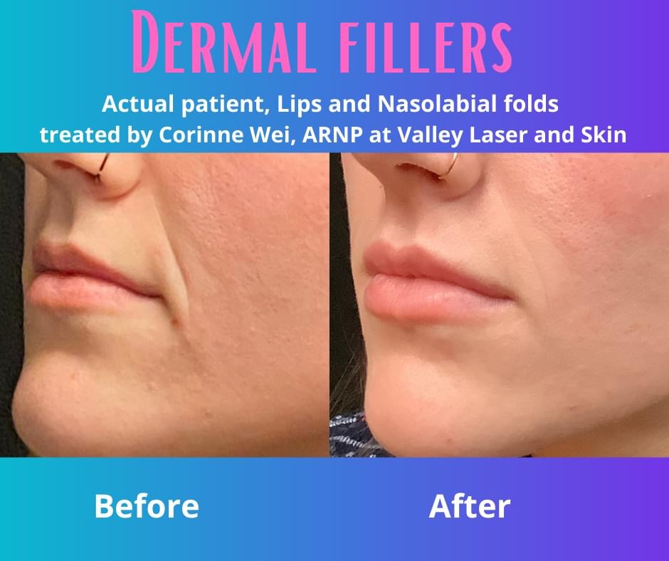 Dermal Fillers – Valley Laser and Skin