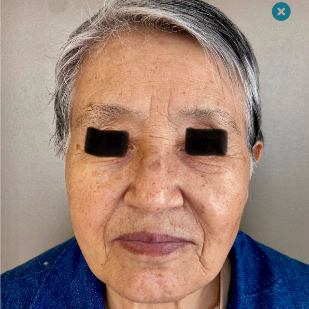 High-Intensity Focused Ultrasound – Valley Laser and Skin