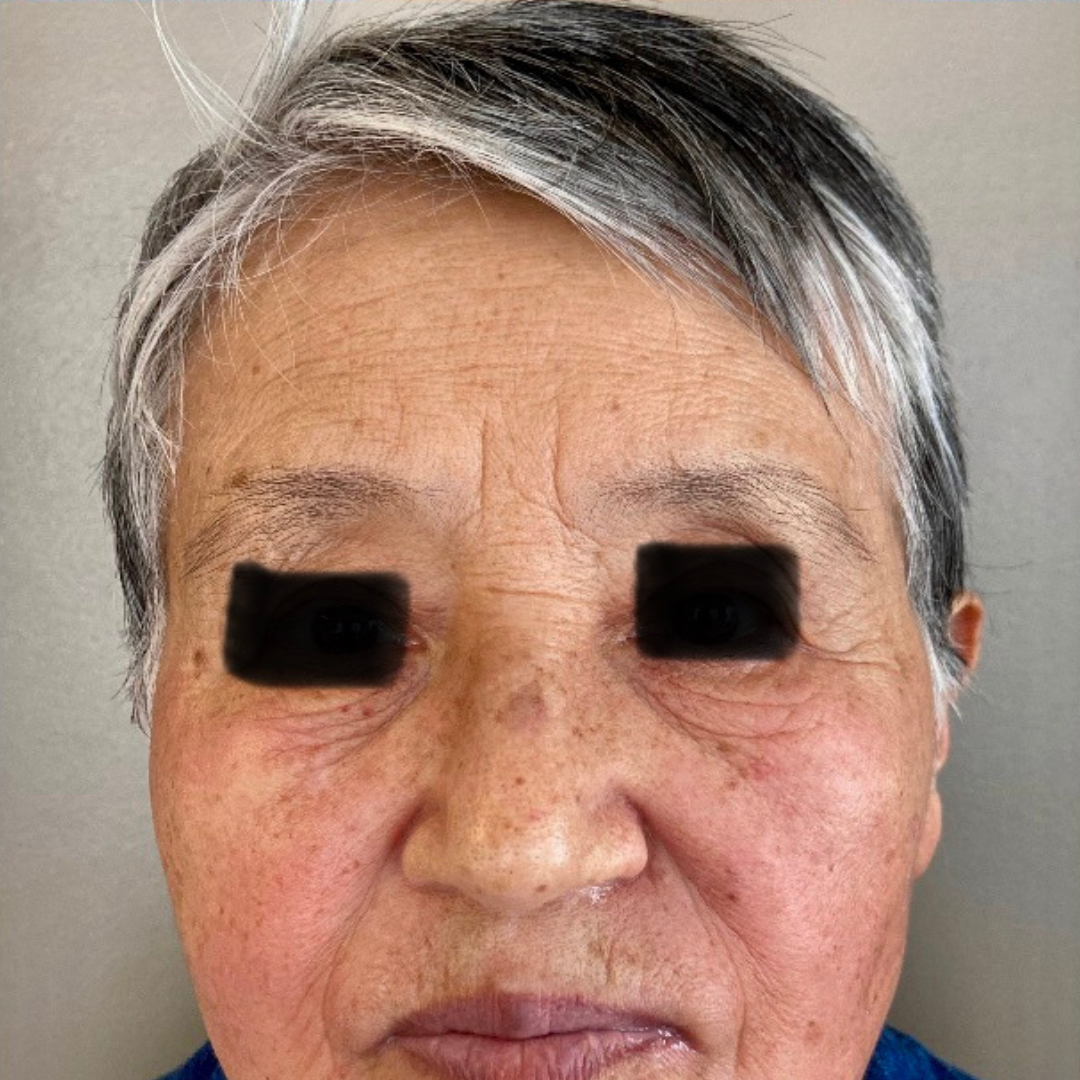 High-Intensity Focused Ultrasound – Valley Laser and Skin