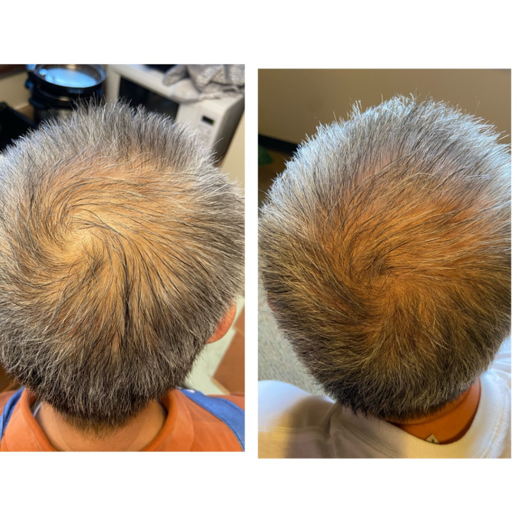 Hair Restoration – Valley Laser and Skin